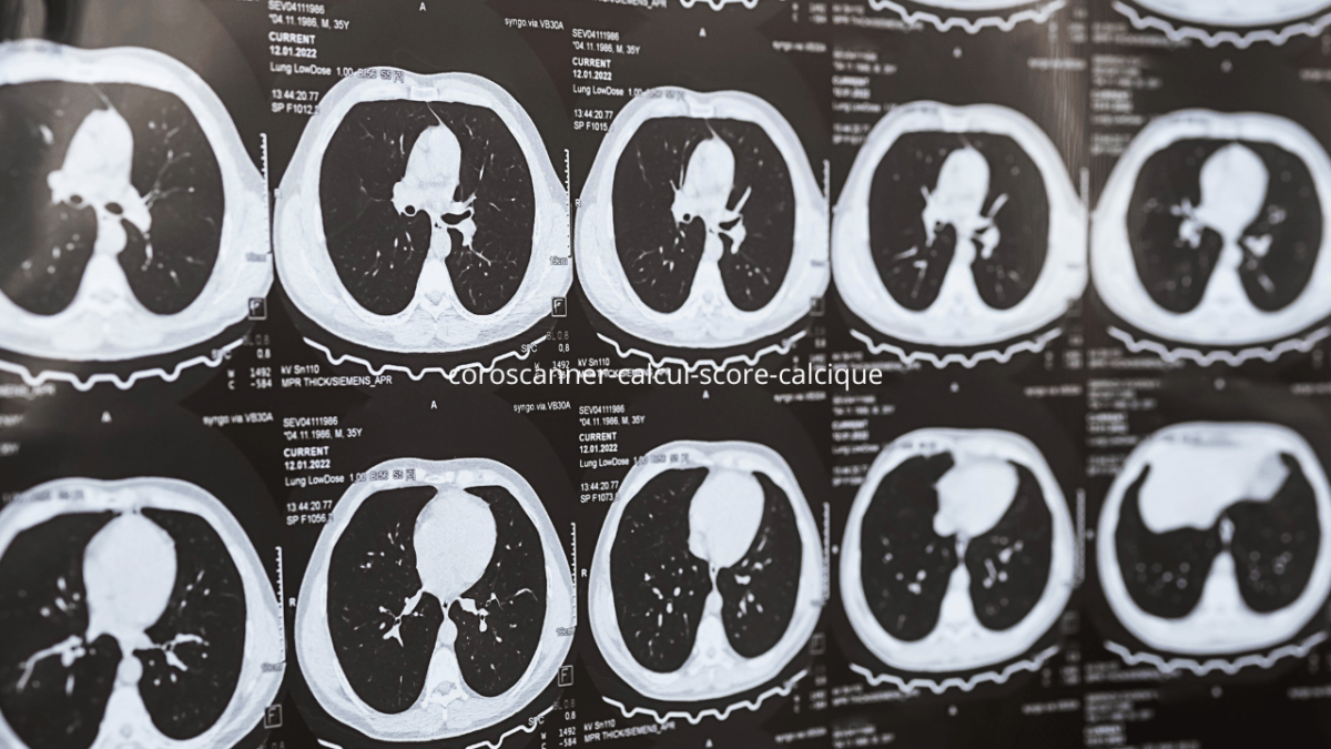 Le coroscanner pour calcul du score calcique